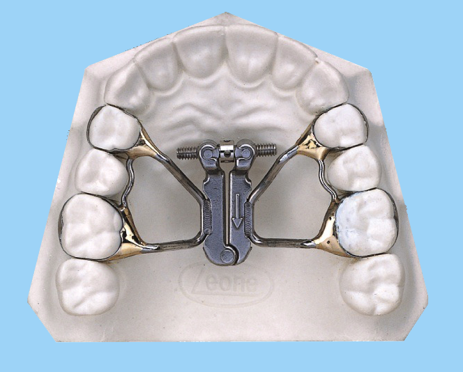 JBC and Company - AA625/09: FAN-TYPE RPE-EXSPIDER